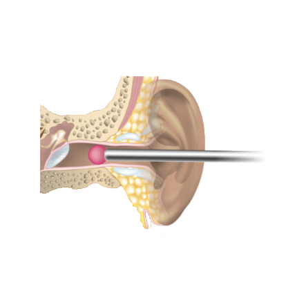 Earwax Removal — Earsonic