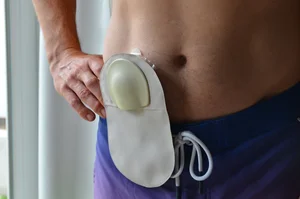 Halo Ostomy Stoma Guard - Stoma Guards for Ostomy, Colostomy ...