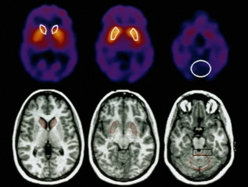 Should I use medications to treat my OCD, part 2