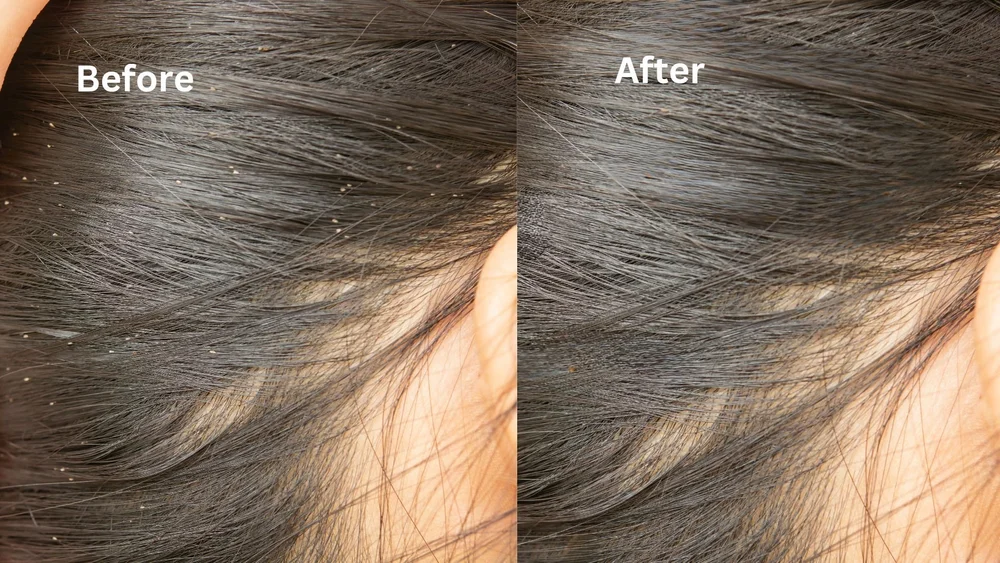 Professional Lice Treatment in Houston | Premier Lice Spa