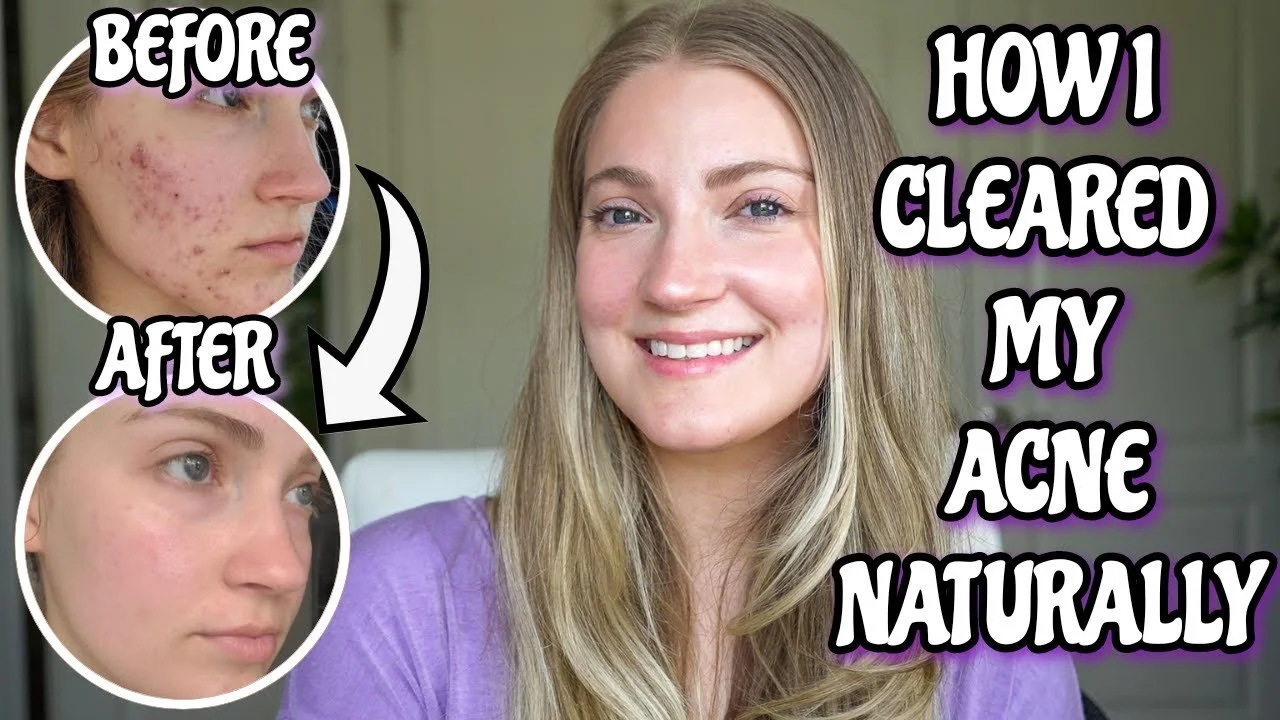 Clear Skin Journey My Updated Guide To Beating Adult Acne — Dani Smith