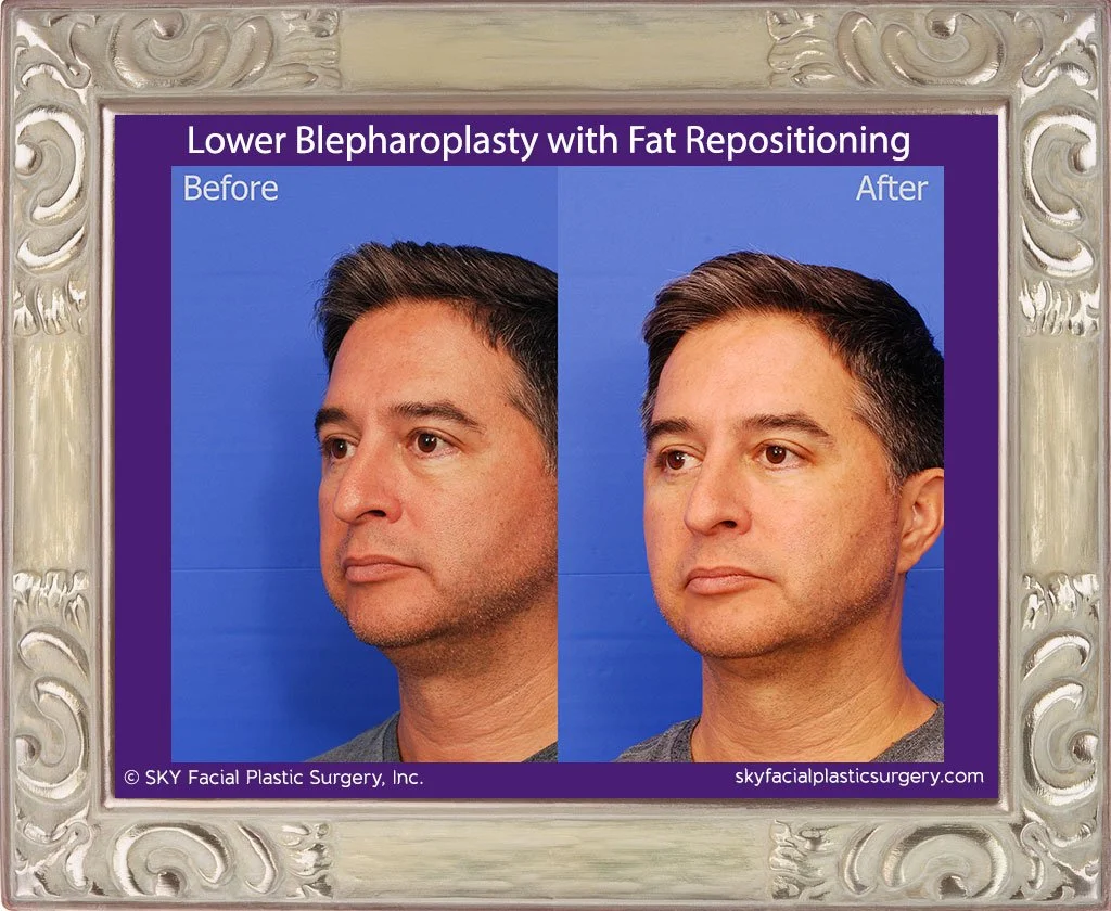 Blepharoplasty Thirteen — SKY Facial Plastic Surgery
