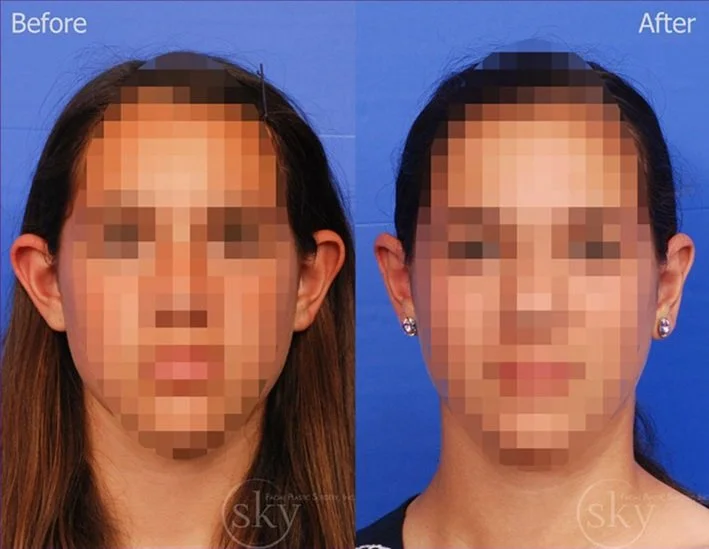Otoplasty Sky Facial Plastic Surgery