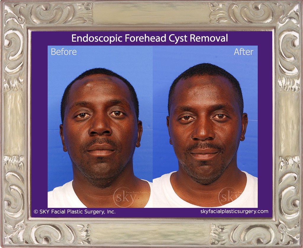 Endoscopic Forehead Cyst Removal — Sky Facial Plastic Surgery