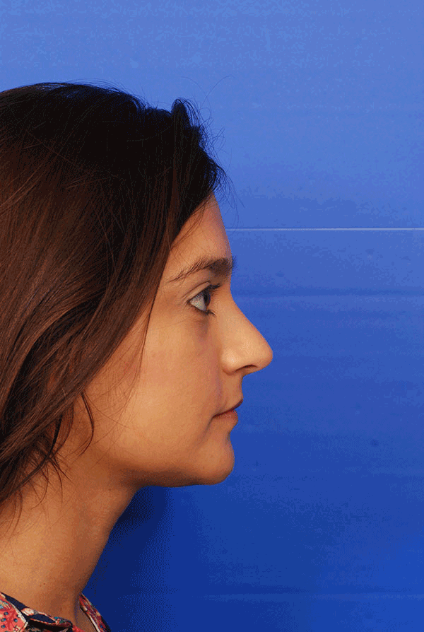 Diary of a New Patient: Rhinoplasty Consultation — SKY Facial Plastic ...