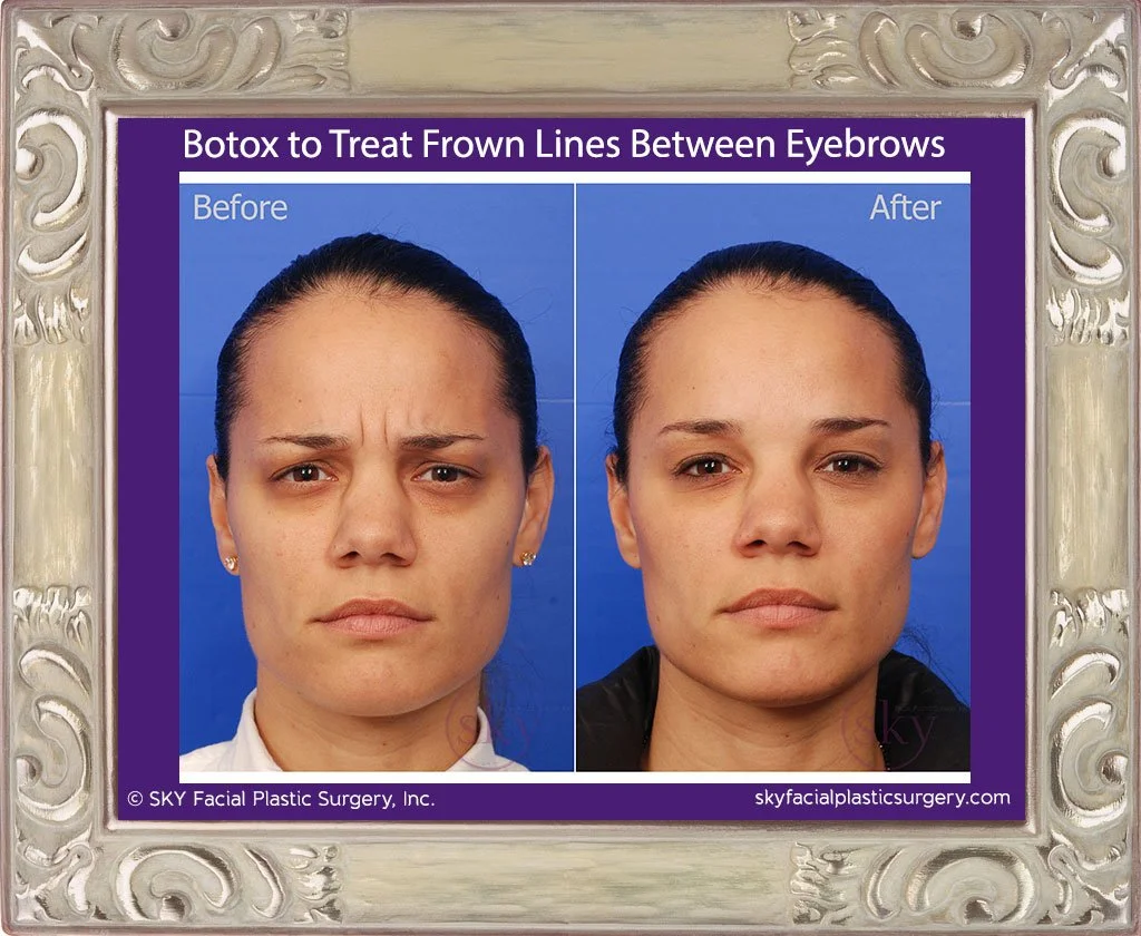 BOTOX TO FOREHEAD AND GLABELLA — SKY Facial Plastic Surgery