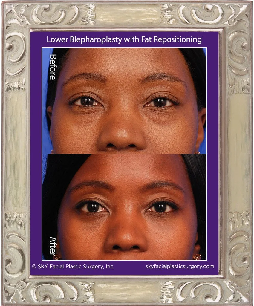 Blepharoplasty Ten — SKY Facial Plastic Surgery