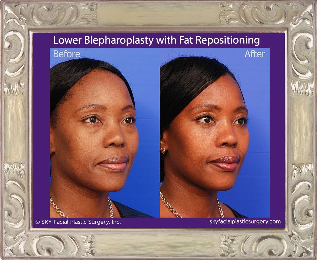 Blepharoplasty Ten — SKY Facial Plastic Surgery