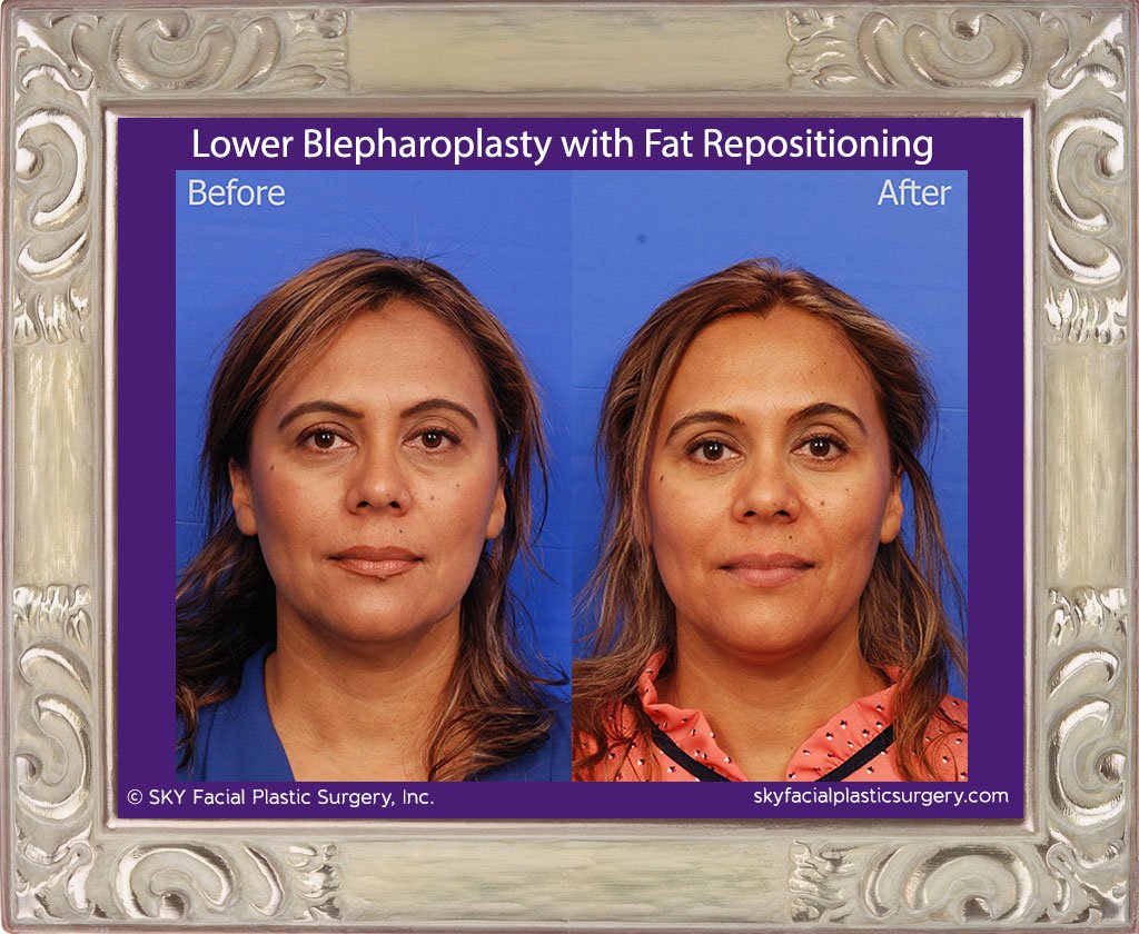 Blepharoplasty Twelve — SKY Facial Plastic Surgery