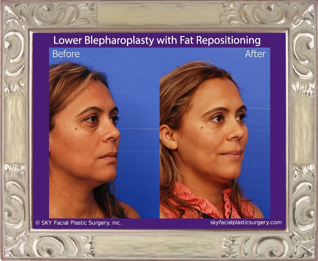 Blepharoplasty Twelve — SKY Facial Plastic Surgery