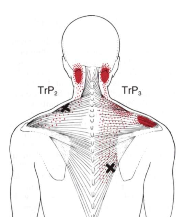 What is a Trigger Point? — Sunstone Medicine
