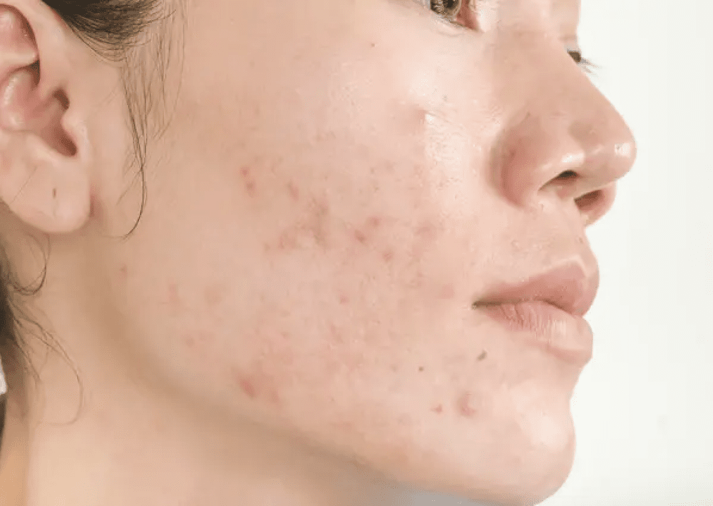 Scars — Greenlane Appearance Medicine