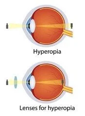 What is hyperopia? — Bukowski & Sexton Eye Care