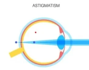 What is astigmatism? — Bukowski & Sexton Eye Care