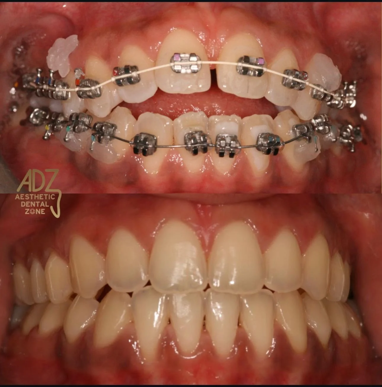 Fixed Appliance - Metal Braces — Dulwich Dental Clinic