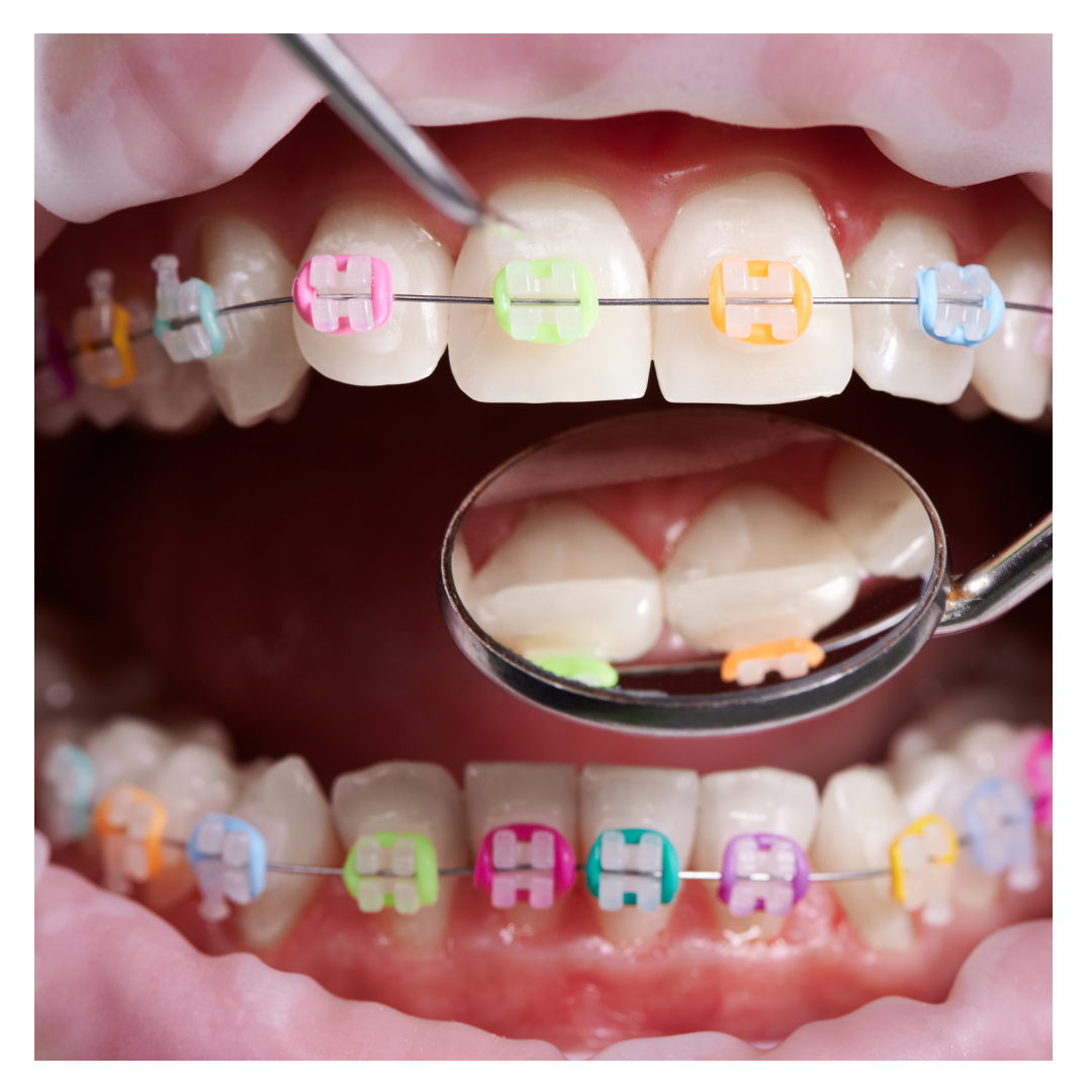 How Long Does It Take To Take Braces Off? — DR GRAY DENTISTRY
