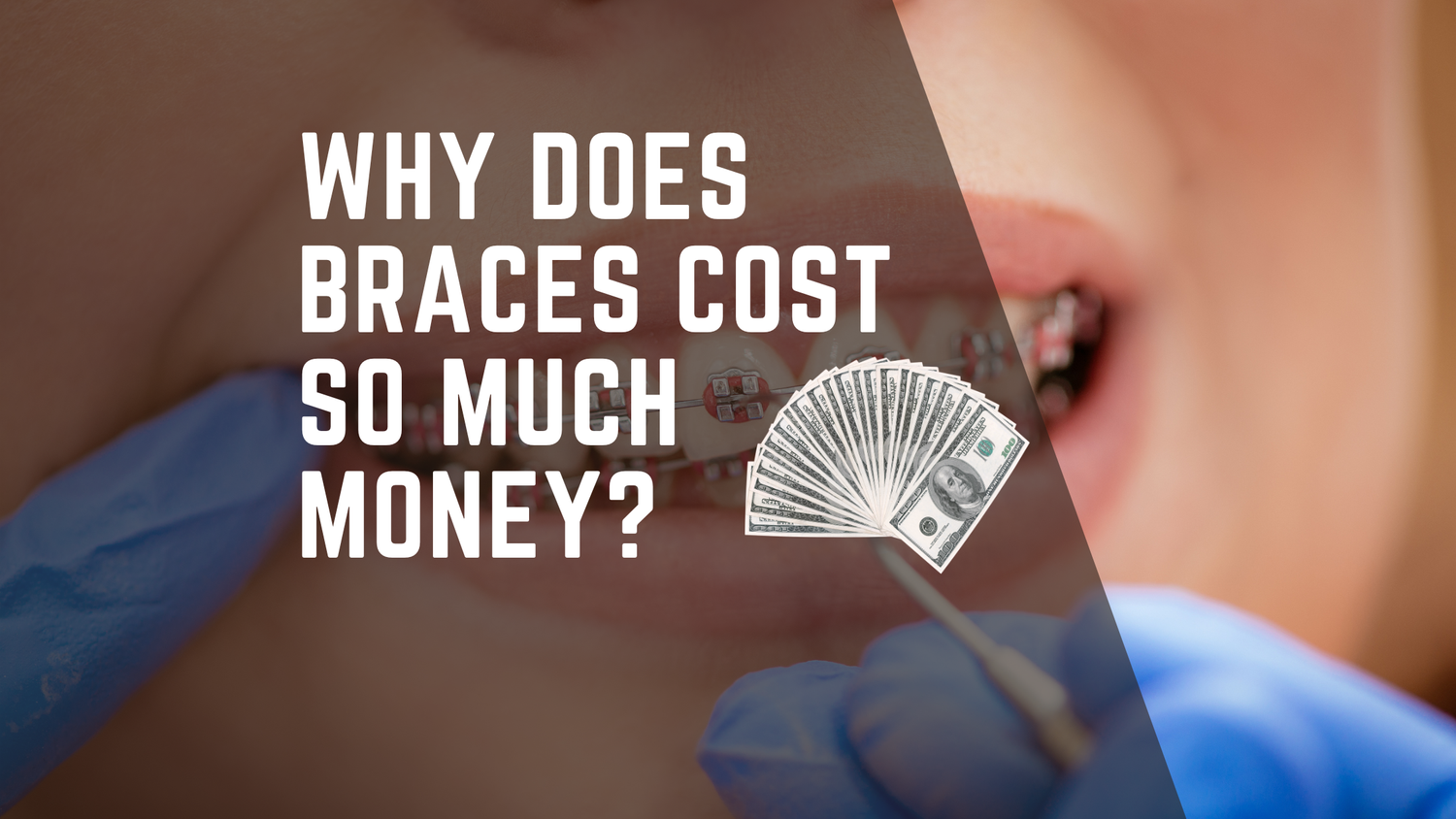 Why Are Braces So Expensive Dr Gray Dentistry