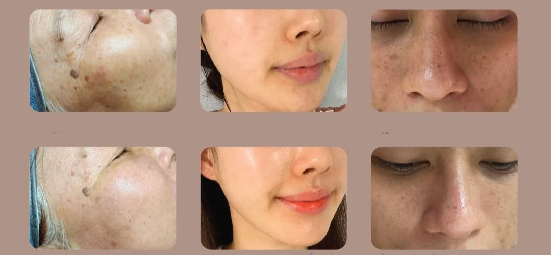 Exosome Therapy | Skin and Hair Rejuvenation | Preserve Aesthetics ...