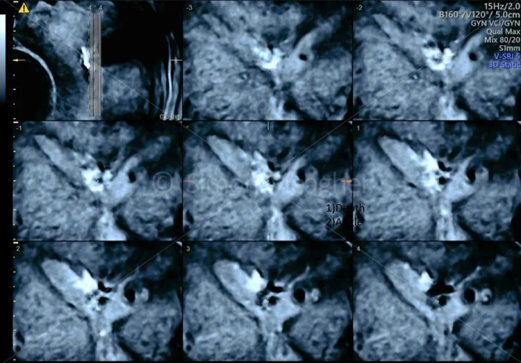 Ashermans Syndrome -Volume Contrast Imaging-Tomographic Slices — Dr ...