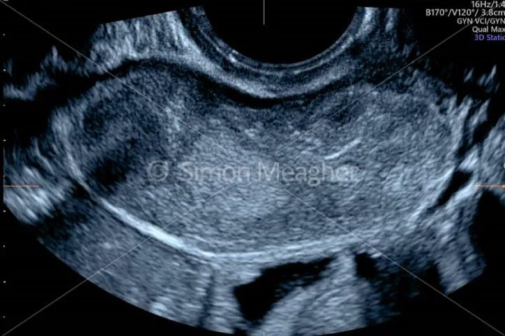 Mucocele of the Appendix 3D static — Dr Simon Events & Webinars