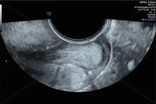 Cervical Polyp -2D — International First Trimester Symposium 31st May ...
