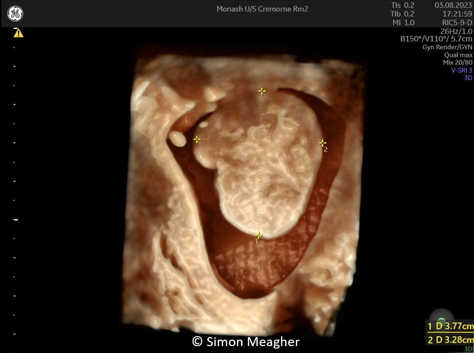 3D Render post saline infusion - Intra-cavity Fibroid — Dr Simon Events ...