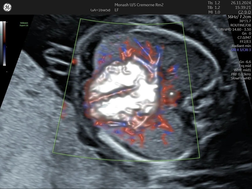 Normal pulmonary vein slow flow at 14W — Dr Simon Events & Webinars