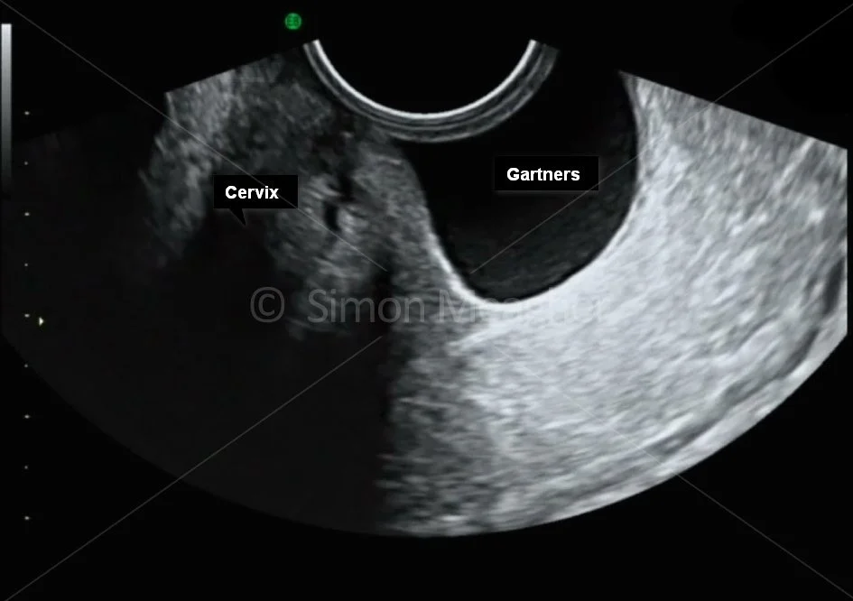 Gartners Duct Simple Cyst — International First Trimester Symposium ...