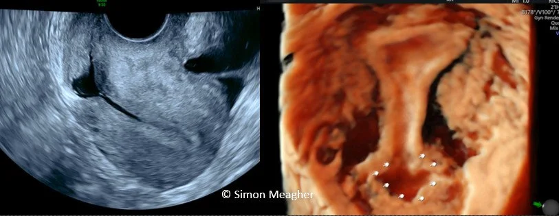 LUSCS Scar Niche- 2D & 3D Render — International First Trimester ...