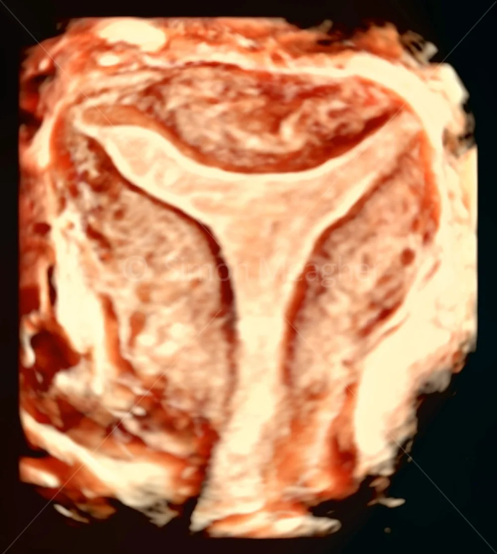Arcuate Uterus 3D HD Live Render — Dr Simon Events & Webinars