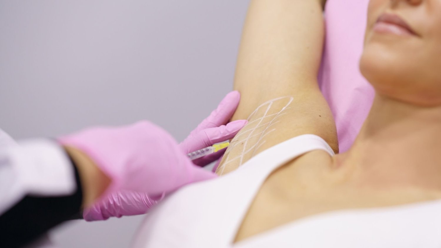 Botox for Sweaty Underarms: Understanding and Managing Excessive ...