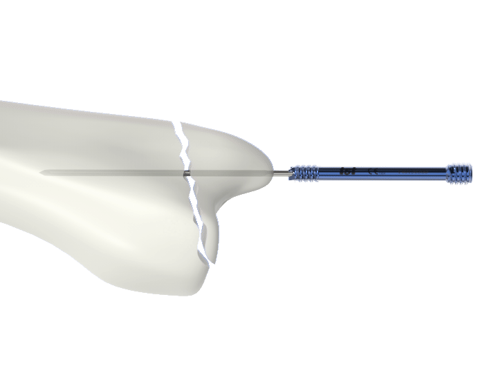 Herbert cannulated compression screw system (TST) — Int2Med Allografts ...
