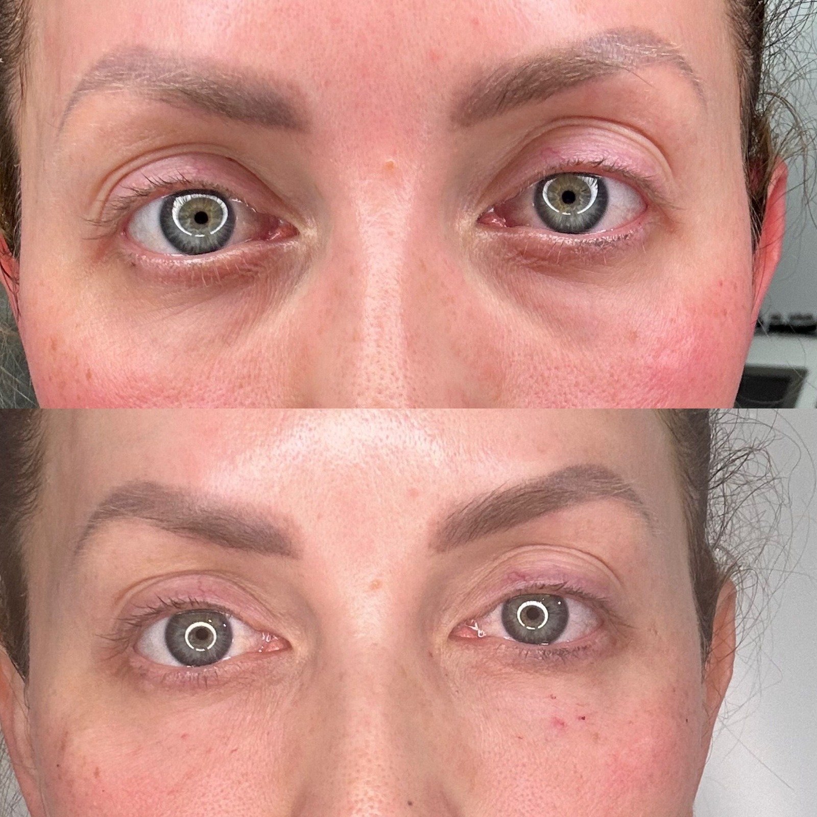 Polynucleotide Treatment — Sevore Aesthetics