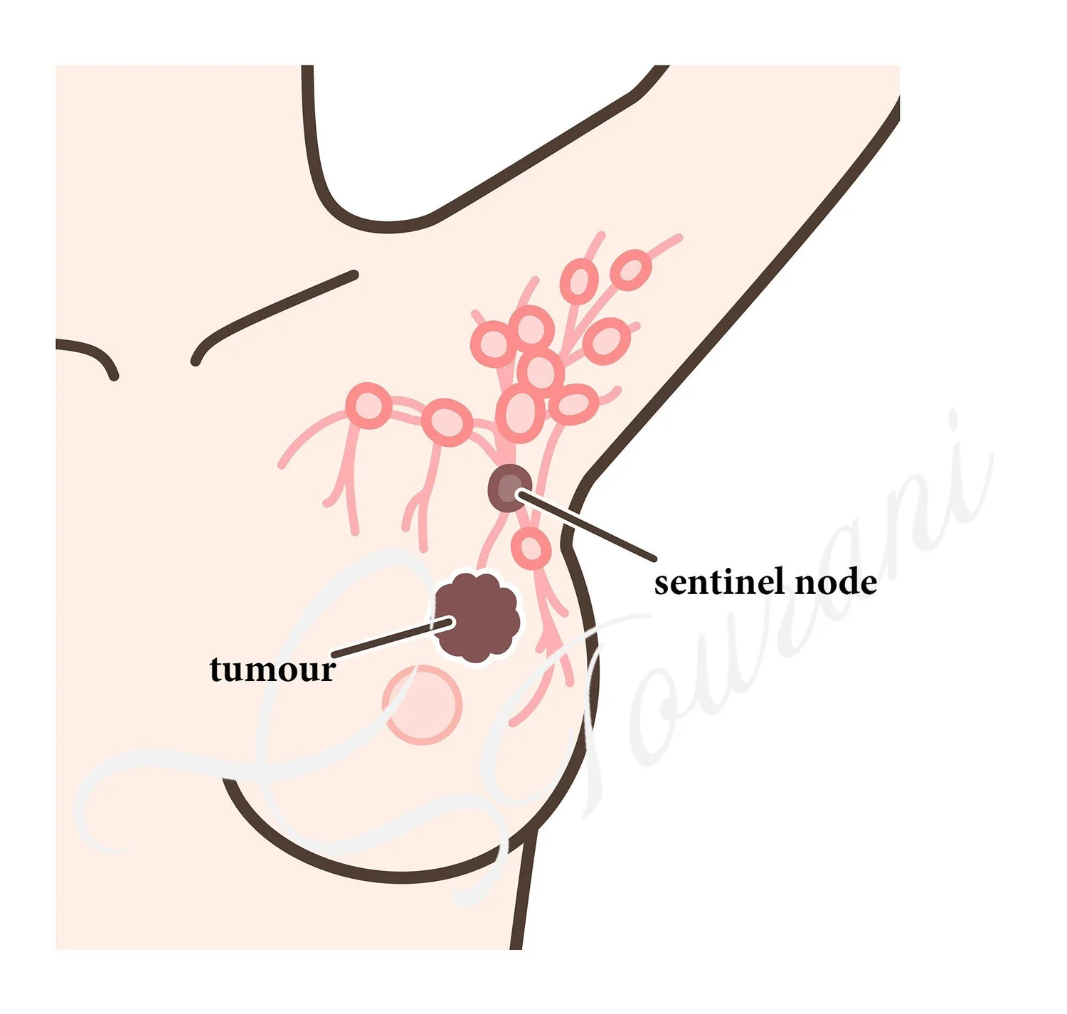 Updates On Armpit Lymph Node Surgery For Breast Cancer