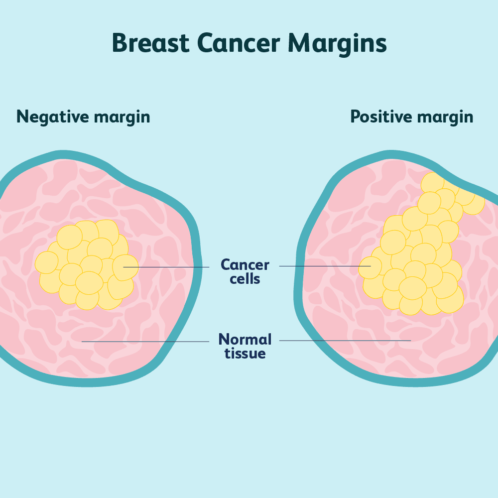 Lumpectomy vs Mastectomy: Choosing the Right Breast Cancer Surgery — DR ...