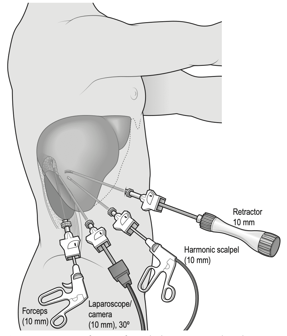 Adrenalectomy: Techniques and Recovery | Dr Tourani