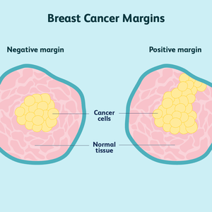 Lumpectomy vs Mastectomy: Breast Cancer Surgery Explained