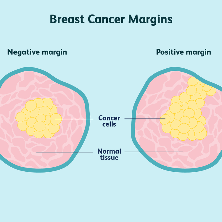 Lumpectomy vs Mastectomy: Breast Cancer Surgery Explained