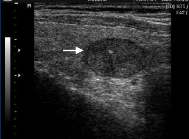 Thyroid Nodules: Diagnosis, Symptoms, and Treatment Options