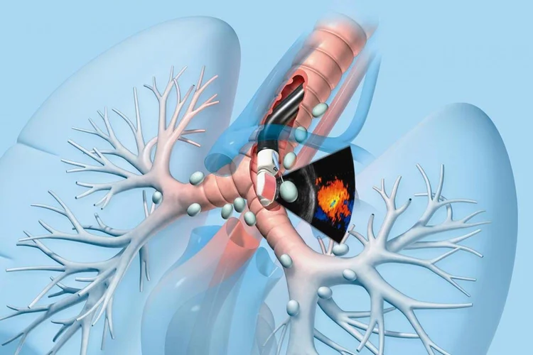 I Need a Bronchoscopy with EBUS – What’s That? — The Lung Docs