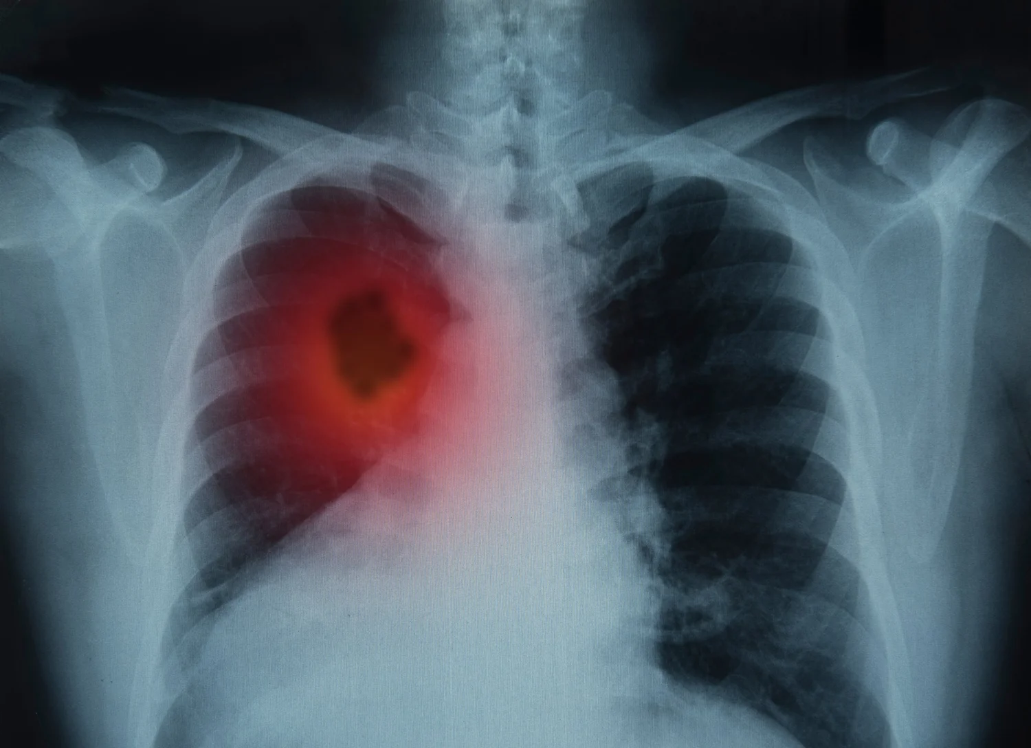 Spotting the Early Signs of Lung Cancer: When To See Your Pulmonologist ...