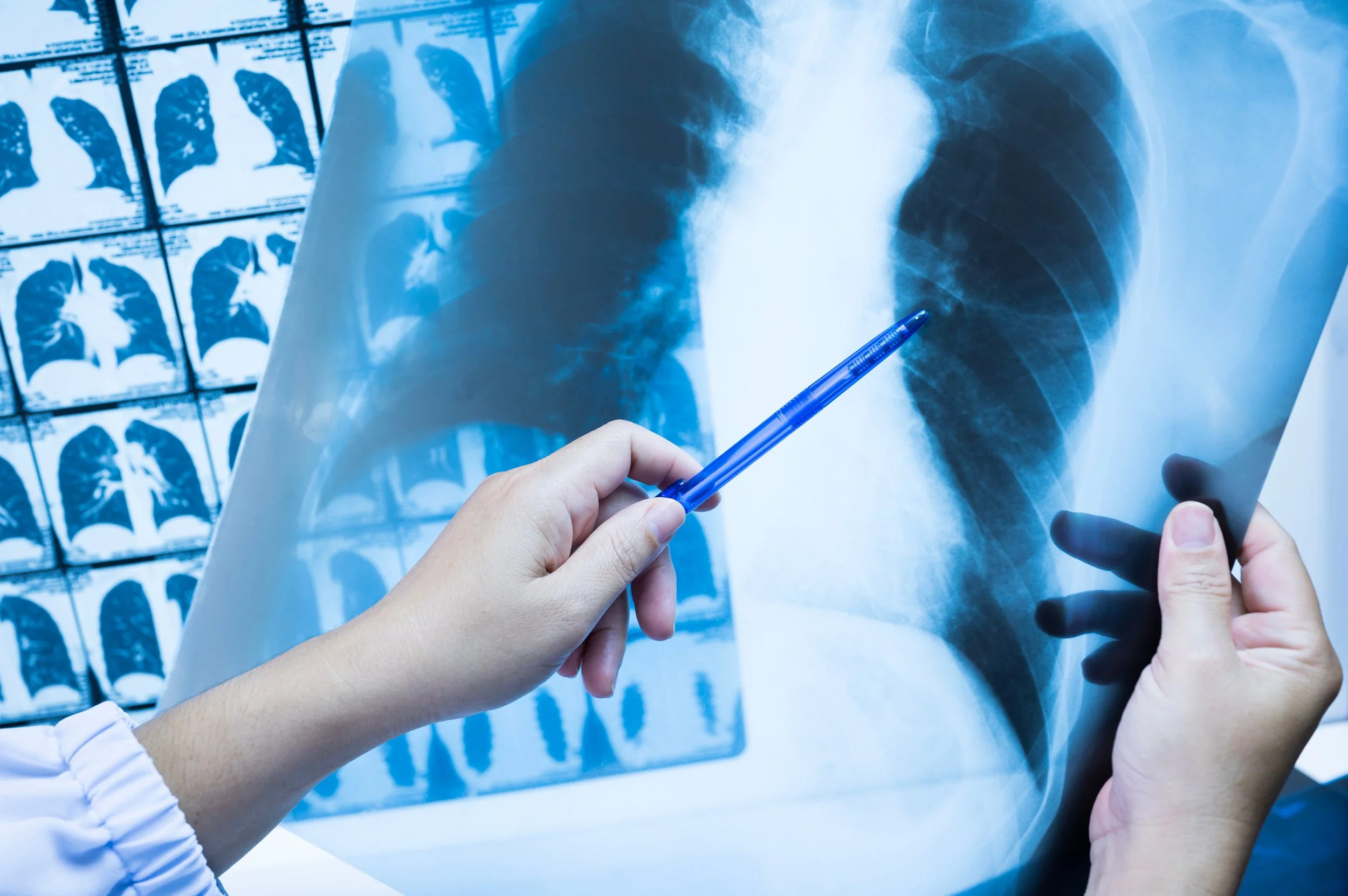 Mediastinal & Hilar Lymphadenopathy — The Lung Docs