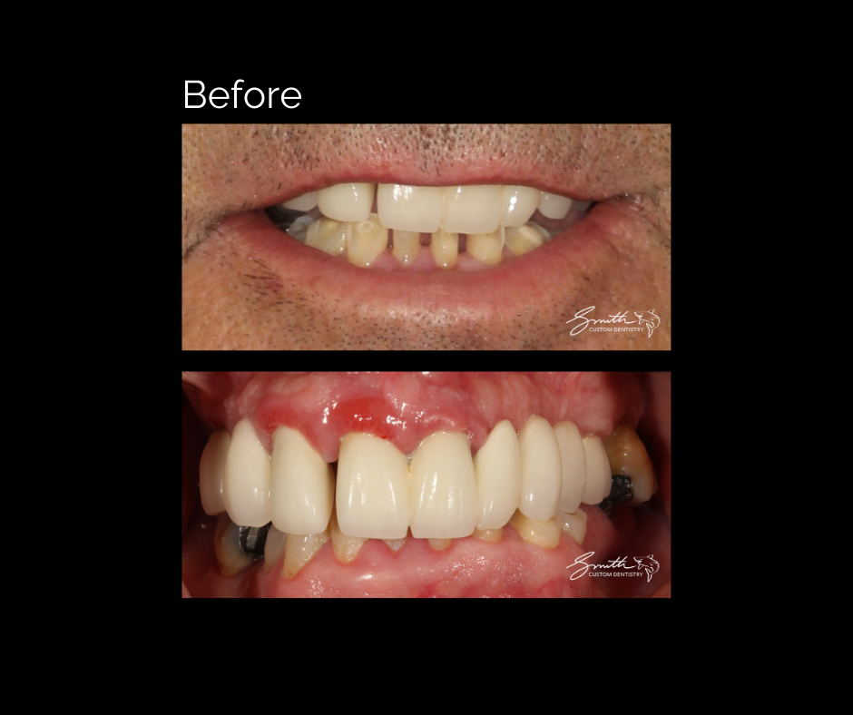 Smith Custom Dentistry — Advanced Restorative Prosthodontics Smile Gallery