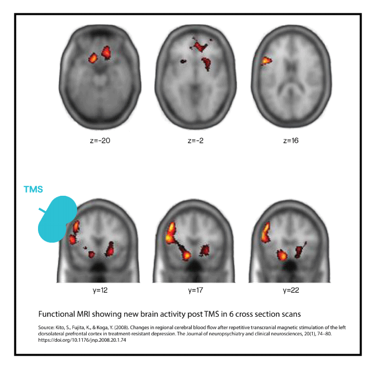 (TMS) Transcranial Magnetic Stimulation Treatment for MDD — Hendricks Therapy - Talk Therapy and ...