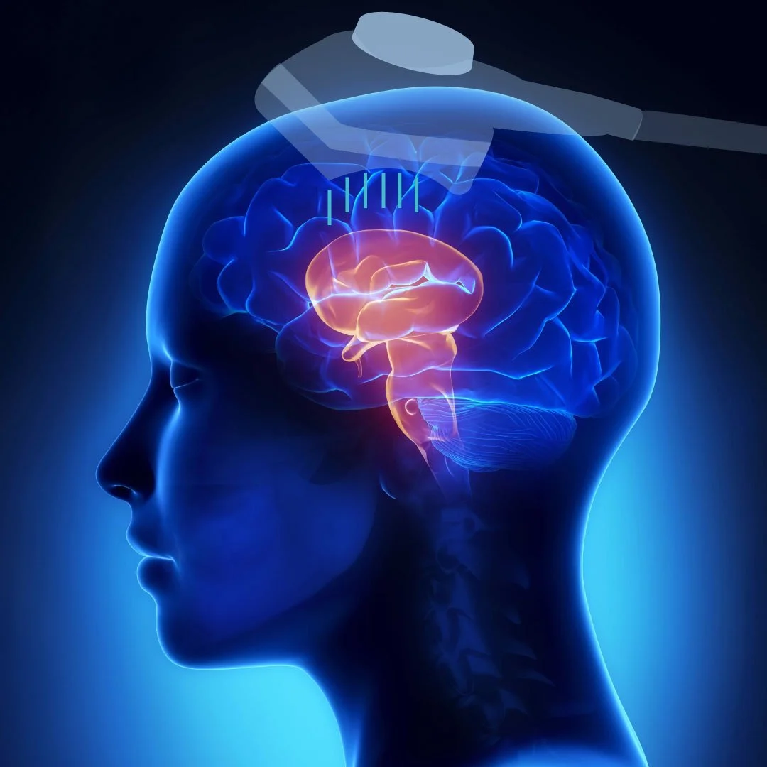 (TMS) Transcranial Magnetic Stimulation Treatment for MDD — Mental ...