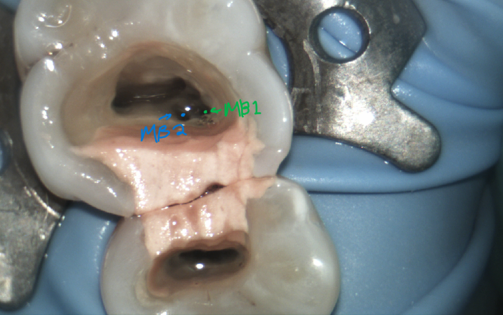 Position of MB2 orifice and upper first and second molars — Peter Le
