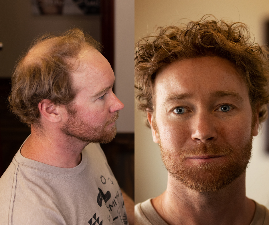 Before and Afters | Discover Your Perfect Look Today — Toupees By Argyle