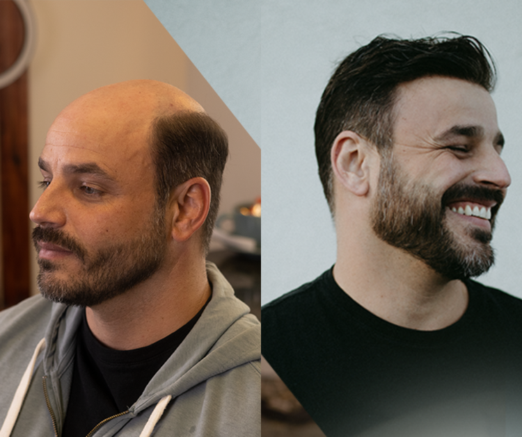 Before and Afters | Discover Your Perfect Look Today — Toupees By Argyle