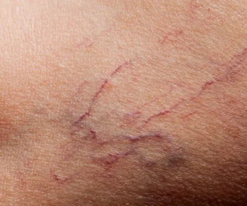 10 Reasons Your Face is Red | Resources — Valley Dermatology