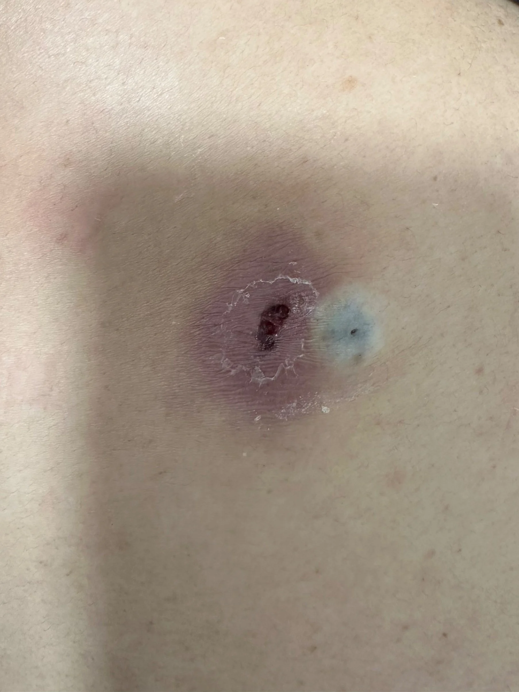 My Cyst Experience — The Frankly